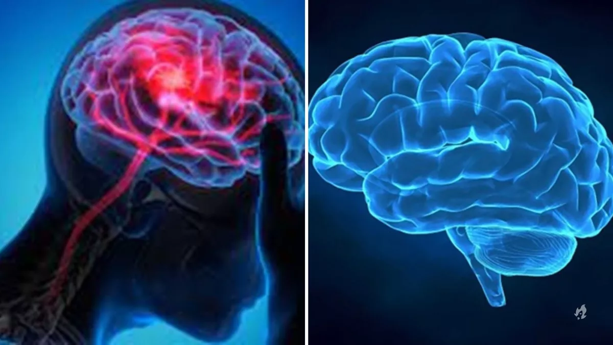 » Sintomas de AVC: saiba os sinais iniciais que podem passar despercebidos